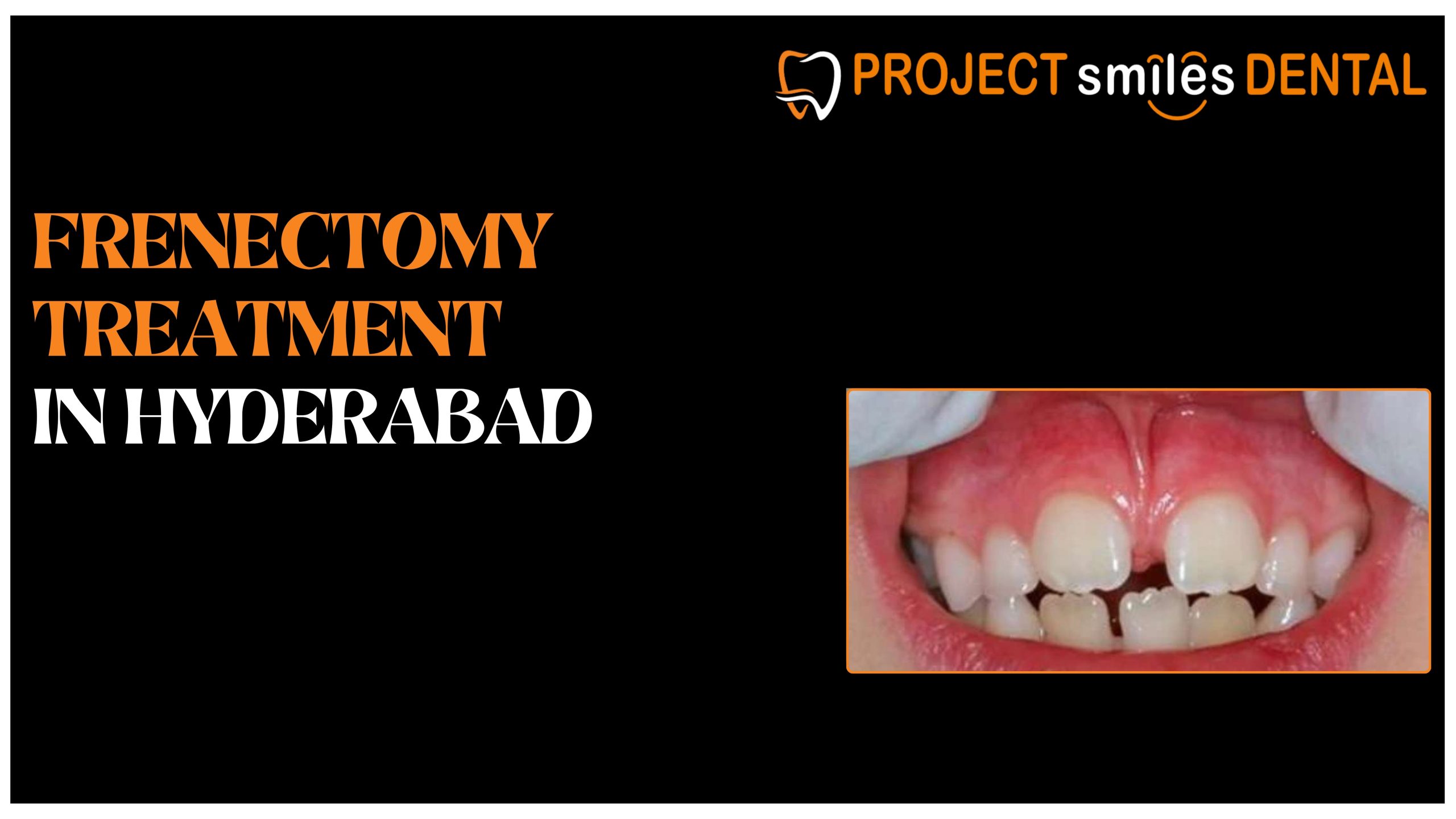 Frenectomy Treatment In Hyderabad Project Smiles Dental