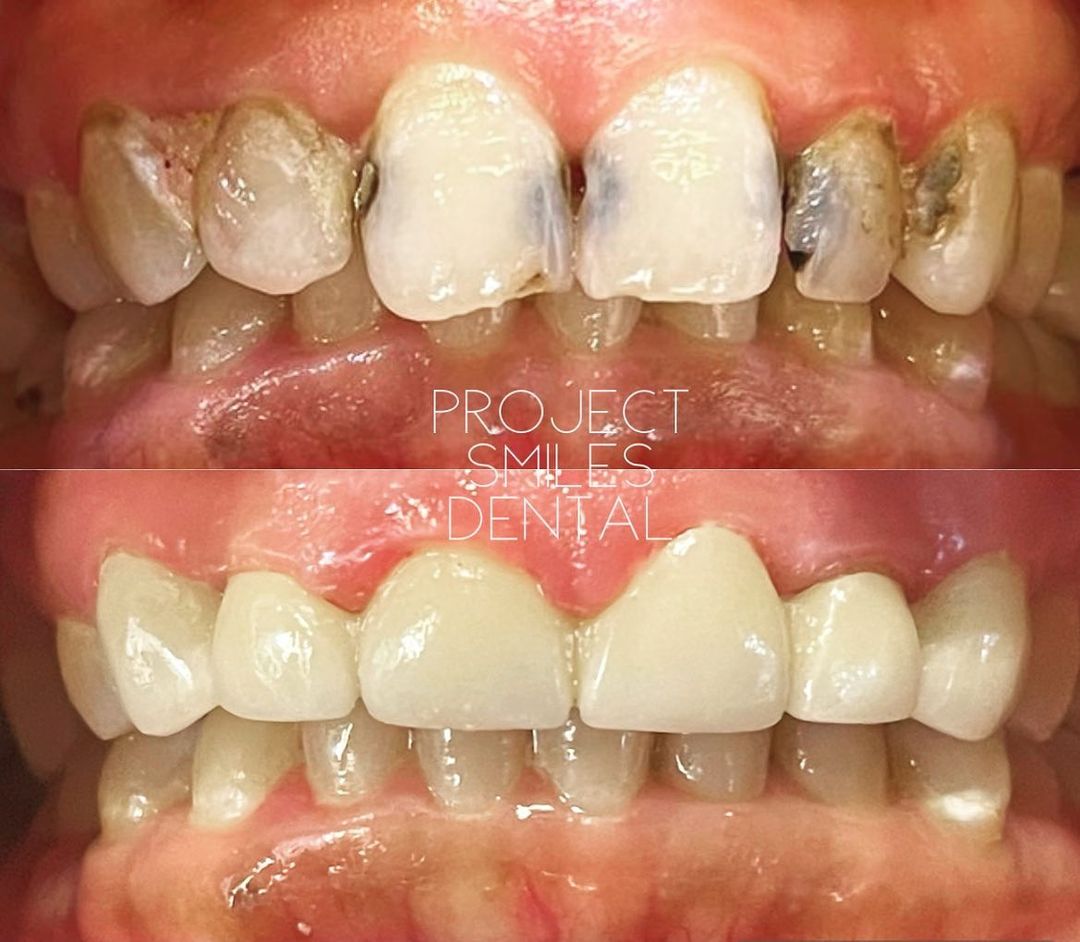 Best Smile Designing in Hyderabad: Treatment, Cost & Benefits