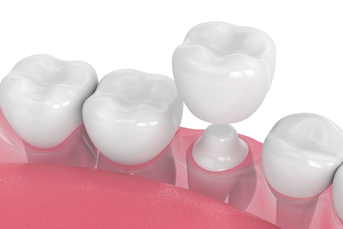Why Do We Place a Crown After Root Canal Treatment