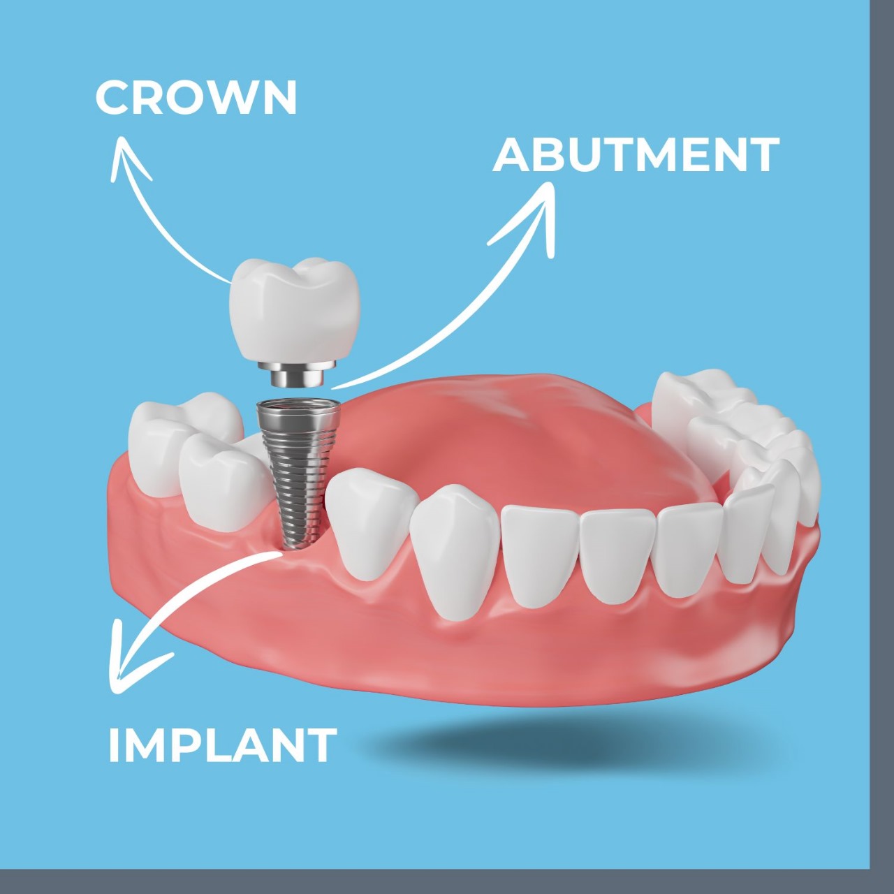 Why Do We Place a Crown After Root Canal Treatment